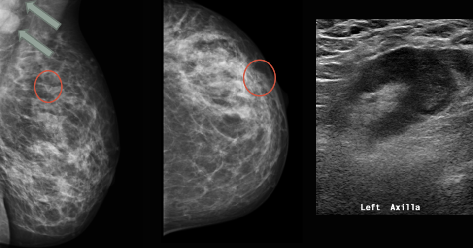 Breast Cancer Staging and Pathology for Mammographers | MTMI