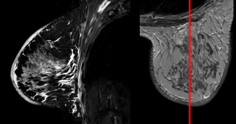 Breast MRI: Advancing Detection and Diagnosis in Women’s Imaging | MTMI