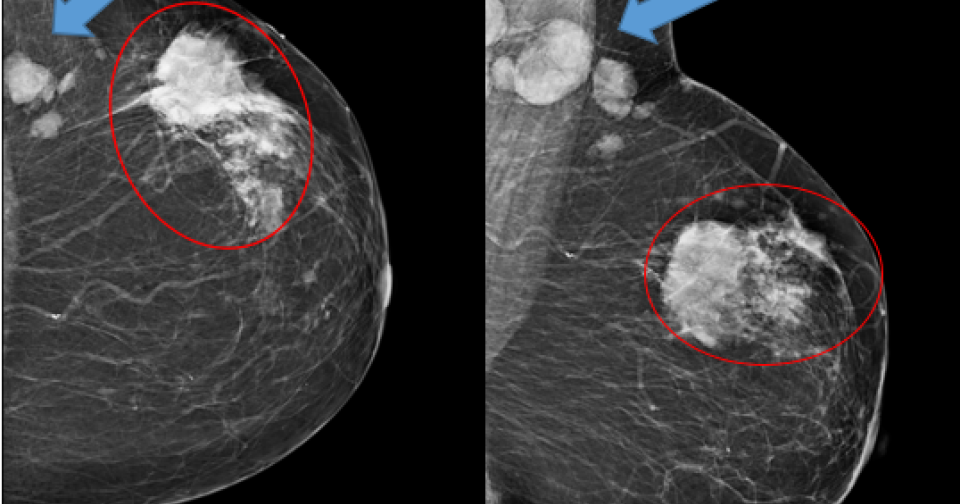 BI-RADS Categories & Modern Mammography | MTMI