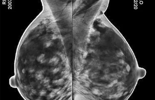 Mammography Registry Review | MTMI